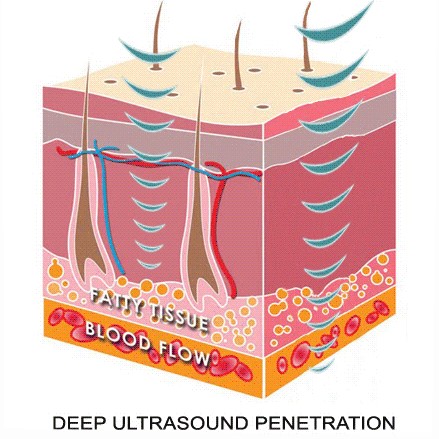 Therapeutic Ultrasound – Full Function Chiropractic
