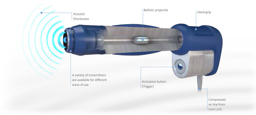 Acoustic Wave Therapy – Full Function Chiropractic